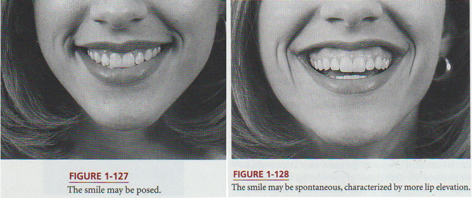 ガミースマイルとは？矯正治療で治るのかを専門医が解説｜ドクターズブログ｜舌側矯正のアイ矯正歯科クリニック